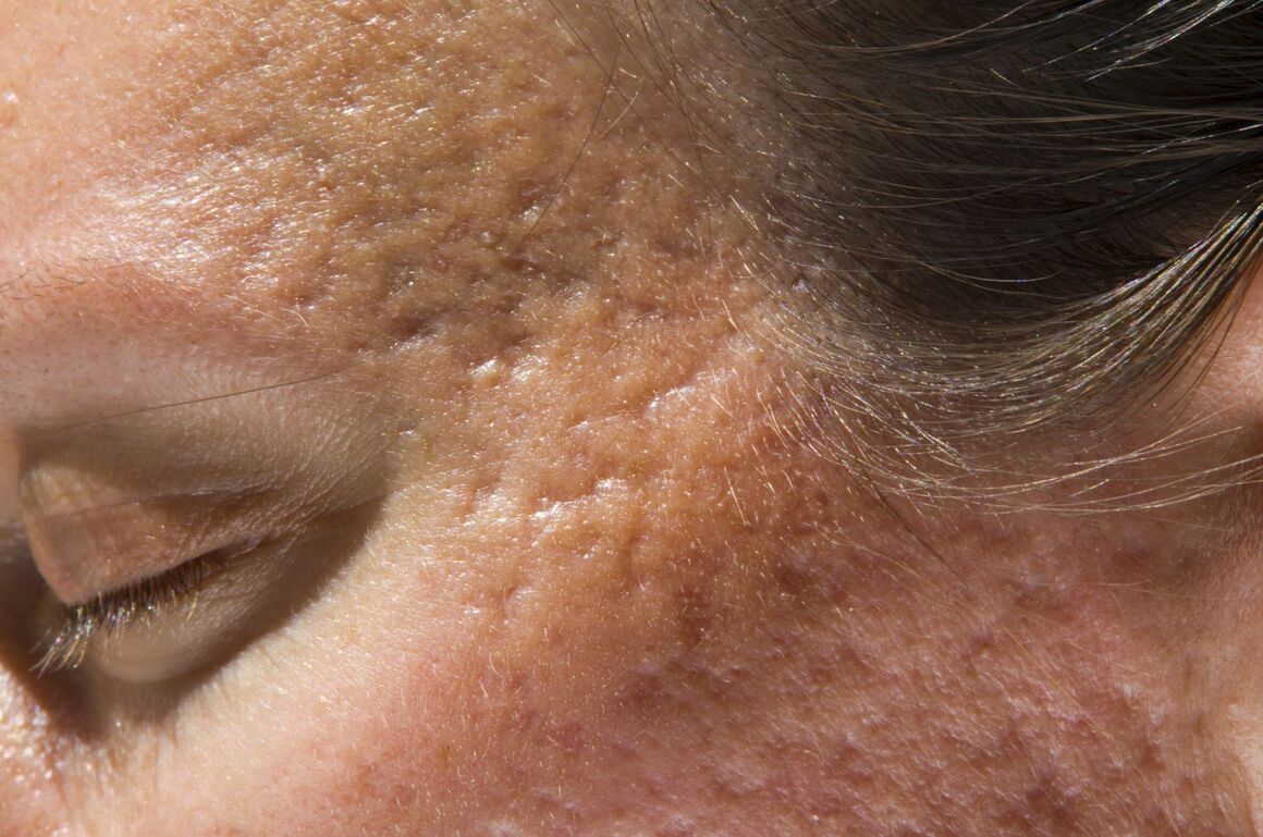 Aknenarben – Wie man vorbeugt und sie wieder los wird | Medipharma